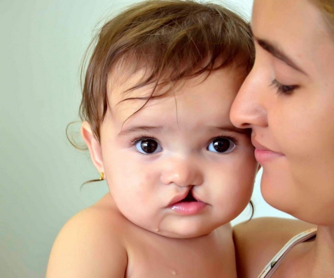 O papel da genética na formação do lábio leporino – Dental Press Portal