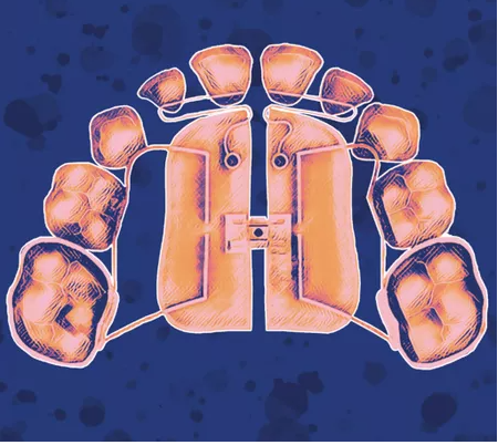 Clinical Orthodontics : Expansor Maxilar de Haas Modificado para ...